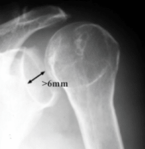 Shoulder Injuries - Approach & Dislocations | Emergency Medicine Cases