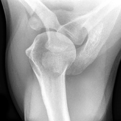 Shoulder Injuries - Approach & Dislocations | Emergency Medicine Cases