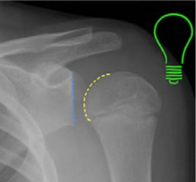 Shoulder Injuries - Approach & Dislocations | Emergency Medicine Cases
