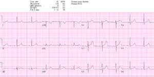 EM cases | ECG cases | First diagonal occlusion
