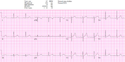 EM cases | ECG cases | First diagonal occlusion