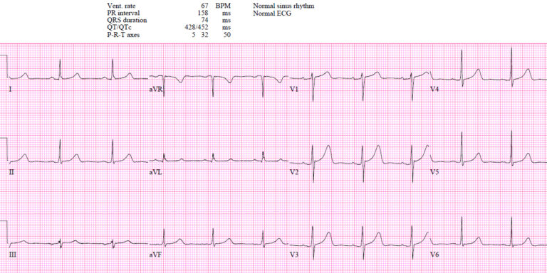 EM cases | ECG cases | First diagonal occlusion