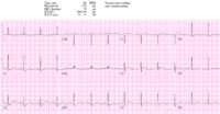 EM cases | ECG cases | First diagonal occlusion