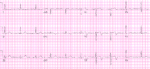 EM cases | ECG cases | First diagonal occlusion