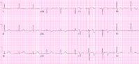 EM cases | ECG cases | First diagonal occlusion