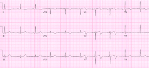 EM cases | ECG cases | First diagonal occlusion