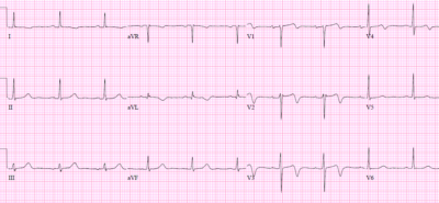 EM cases | ECG cases | First diagonal occlusion