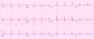 EM cases | ECG cases | First diagonal occlusion