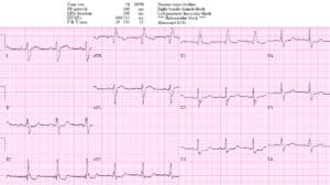 EM cases | ECG cases | First diagonal occlusion