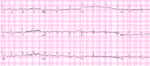 EM cases | ECG cases | First diagonal occlusion