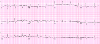 EM cases | ECG cases | First diagonal occlusion