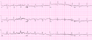 EM cases | ECG cases | First diagonal occlusion