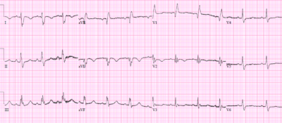 EM cases | ECG cases | First diagonal occlusion