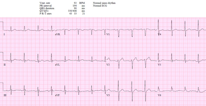 EM cases | ECG cases | First diagonal occlusion