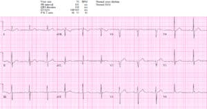 EM cases | ECG cases | First diagonal occlusion