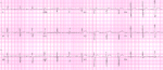 EM cases | ECG cases | First diagonal occlusion