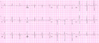 EM cases | ECG cases | First diagonal occlusion