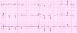 EM cases | ECG cases | First diagonal occlusion