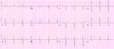 EM cases | ECG cases | First diagonal occlusion