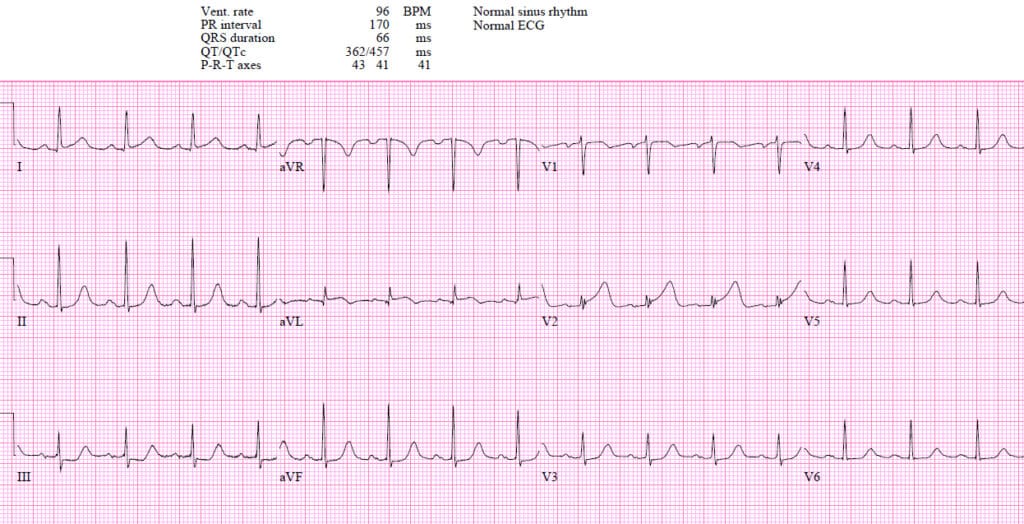 EM cases | ECG cases | First diagonal occlusion