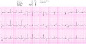 EM cases | ECG cases | First diagonal occlusion