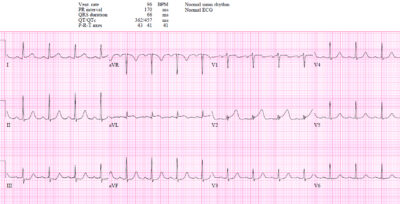 EM cases | ECG cases | First diagonal occlusion