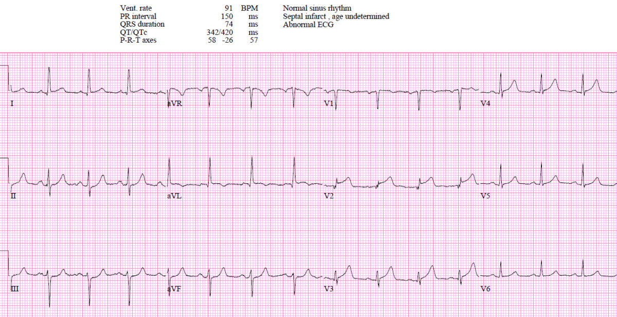 EM cases | ECG cases | First diagonal occlusion