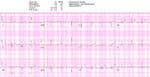 EM cases | ECG cases | First diagonal occlusion