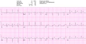 EM cases | ECG cases | First diagonal occlusion