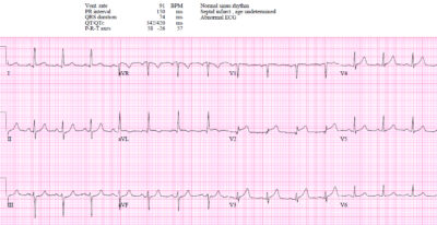 EM cases | ECG cases | First diagonal occlusion