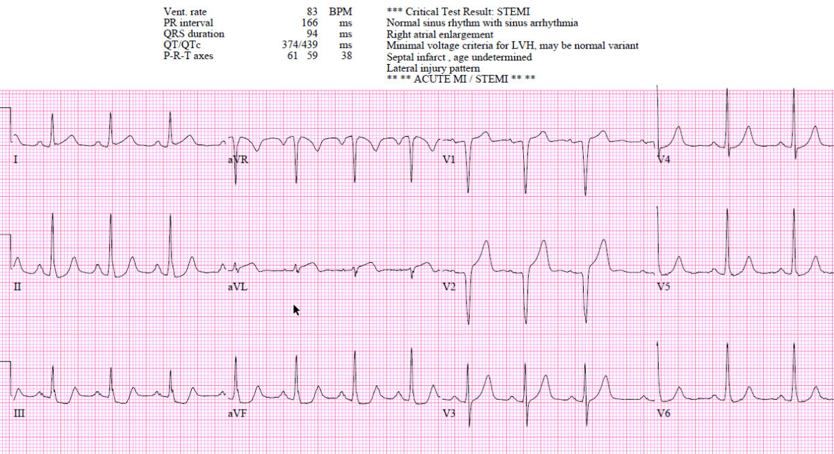 EM cases | ECG cases | First diagonal occlusion