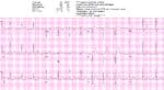 EM cases | ECG cases | First diagonal occlusion