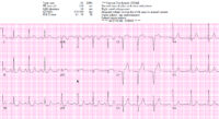 EM cases | ECG cases | First diagonal occlusion