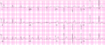 EM cases | ECG cases | First diagonal occlusion