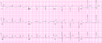 EM cases | ECG cases | First diagonal occlusion