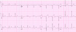 EM cases | ECG cases | First diagonal occlusion