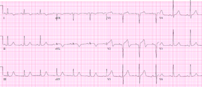 EM cases | ECG cases | First diagonal occlusion