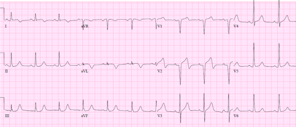 EM cases | ECG cases | First diagonal occlusion