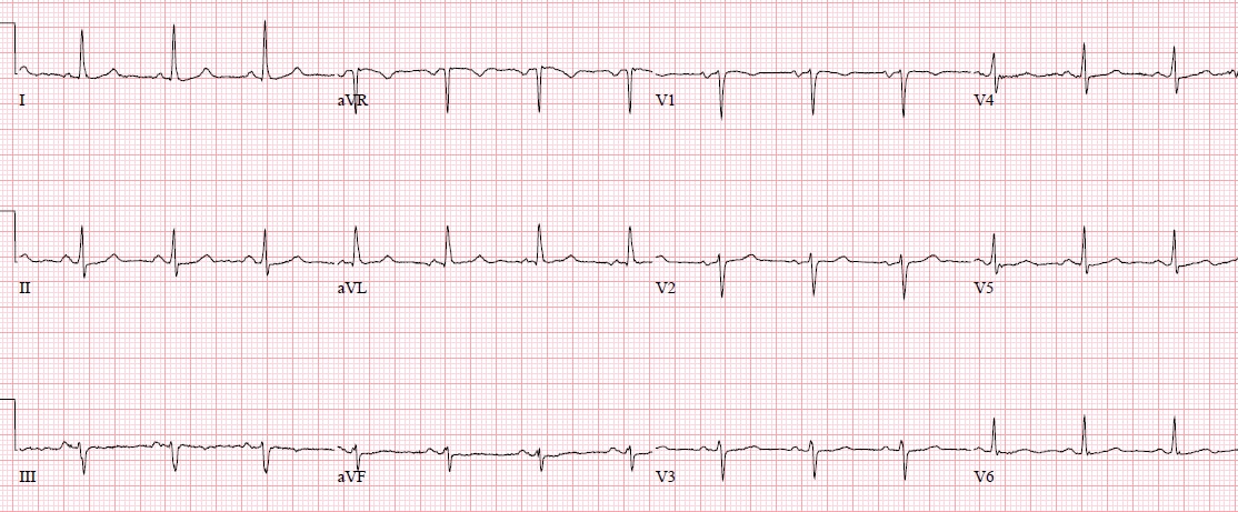 Cardiovascular emergencies and COVID-19 | ECG cases | Emergency ...