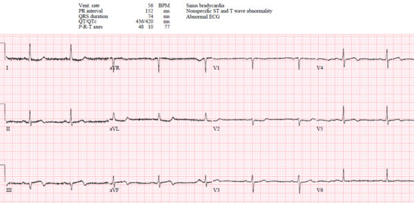 Cardiovascular emergencies and COVID-19 | ECG cases | Emergency ...