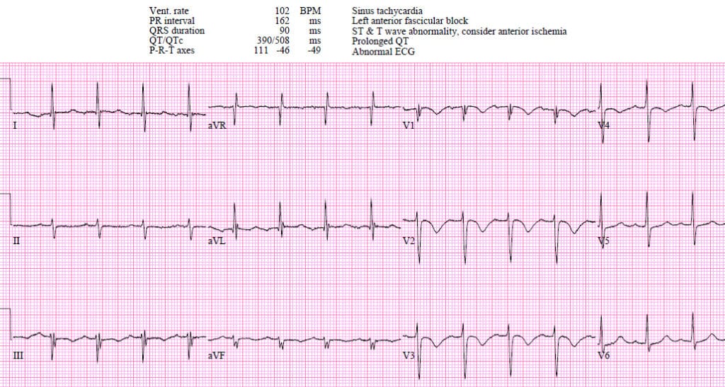 Cardiovascular emergencies and COVID-19 | ECG cases | Emergency ...
