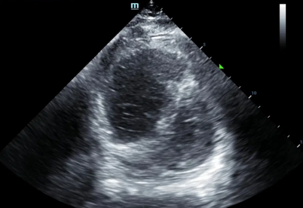 Cardiovascular emergencies and COVID-19 | ECG cases | Emergency ...