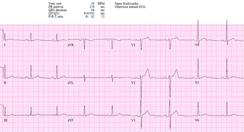 Cardiovascular emergencies and COVID-19 | ECG cases | Emergency ...