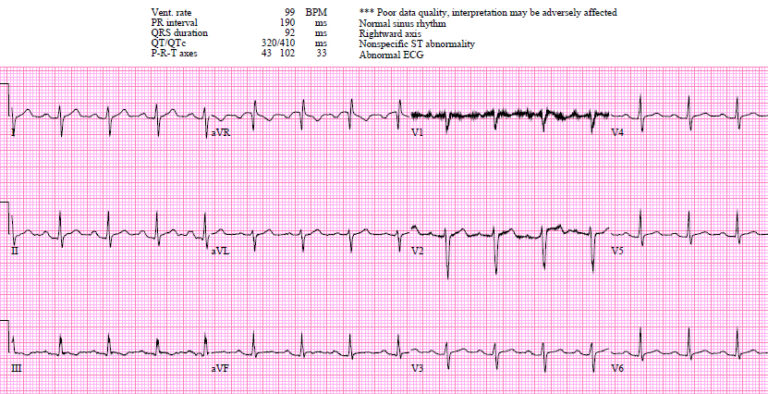 Cardiovascular emergencies and COVID-19 | ECG cases | Emergency ...