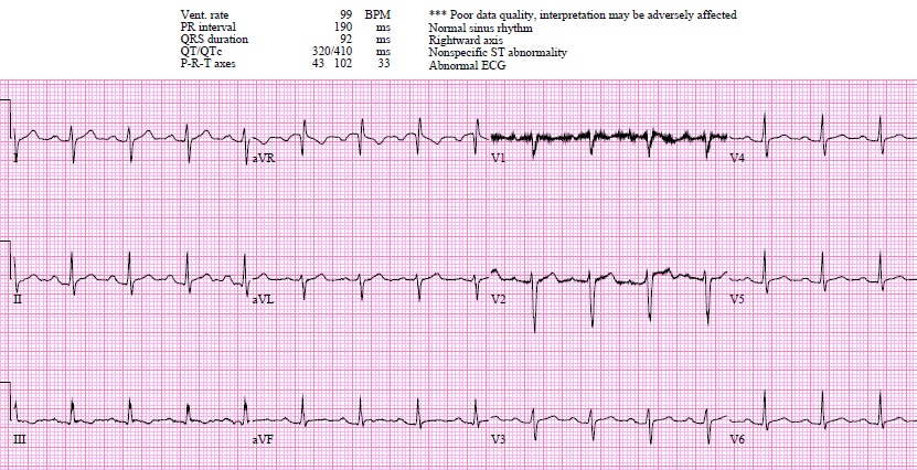 Cardiovascular emergencies and COVID-19 | ECG cases | Emergency ...