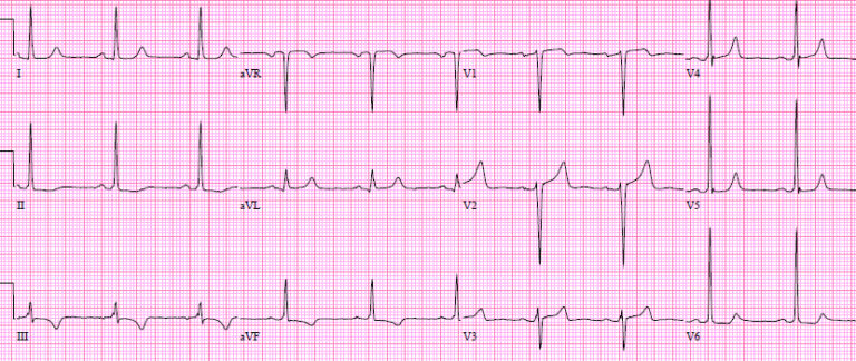Cardiovascular emergencies and COVID-19 | ECG cases | Emergency ...