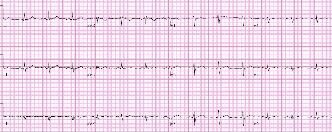 Cardiovascular emergencies and COVID-19 | ECG cases | Emergency ...