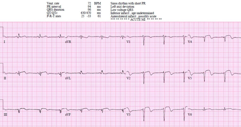 Cardiovascular emergencies and COVID-19 | ECG cases | Emergency ...