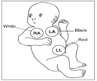 Neonatal Resuscitation | Emergency Medicine Cases | EM Cases