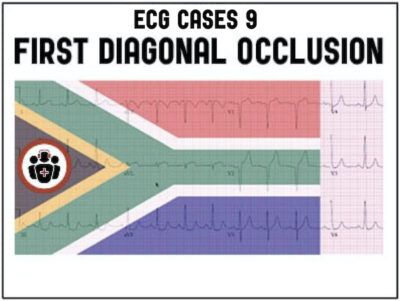 EM cases | ECG cases | First diagonal occlusion